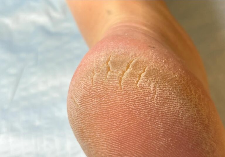 Skin trims and heel splints - Pediluxus Studio - Professional pedicure ...